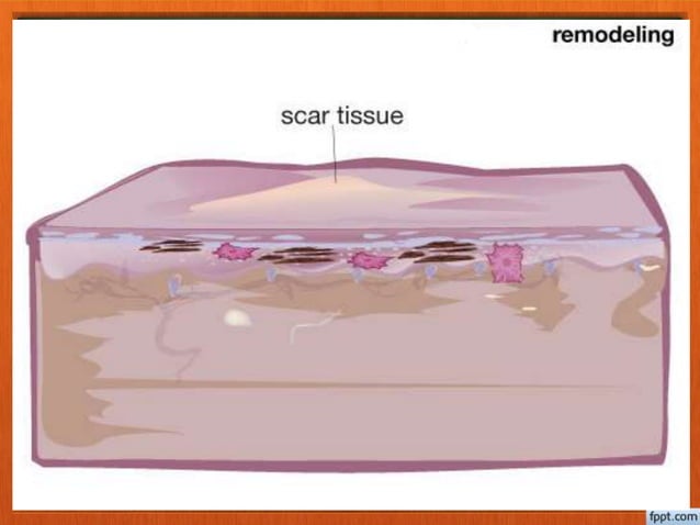 4 wound healing dr. haydar muneer salih | PPTX