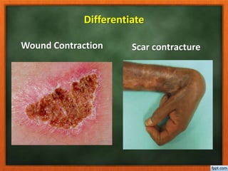 4 wound healing dr. haydar muneer salih | PPTX