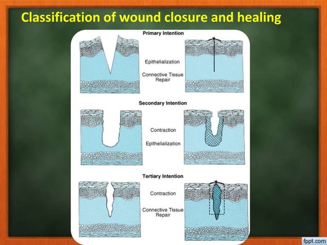 4 wound healing dr. haydar muneer salih | PPTX