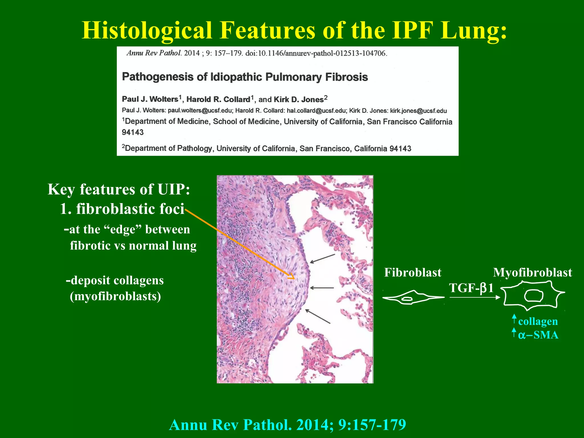 Idiopathic Pulmonary Fibrosis (IPF) | PPT