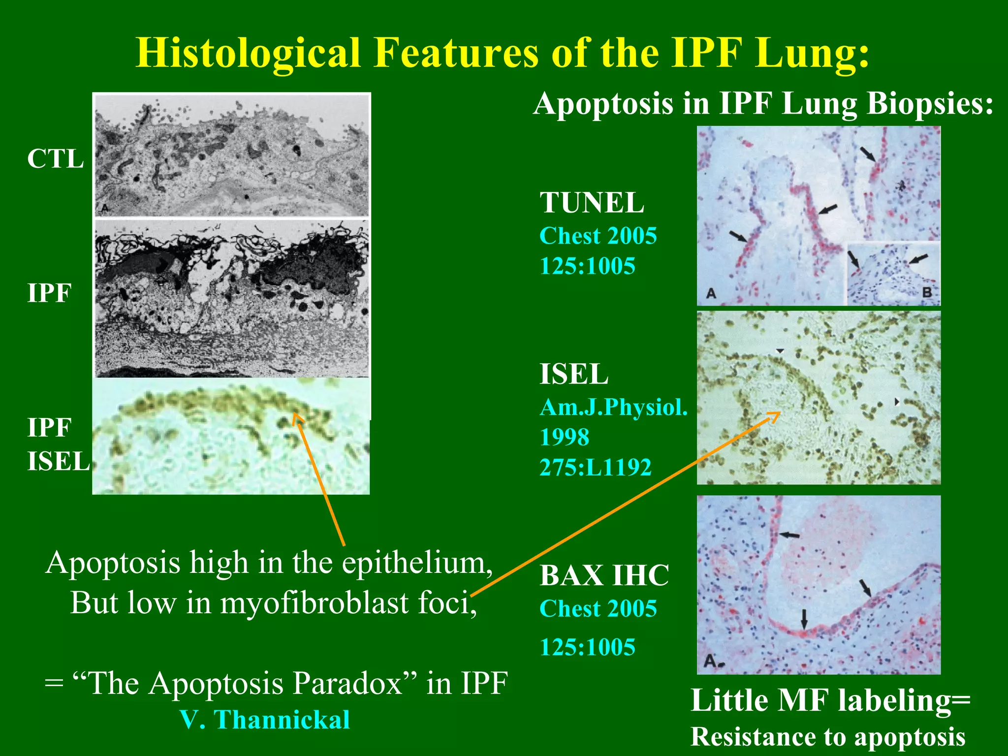 Idiopathic Pulmonary Fibrosis (IPF) | PPT