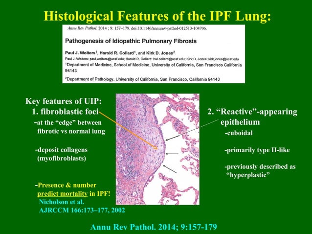 Idiopathic Pulmonary Fibrosis (IPF) | PPT | Lung and Respiratory Health ...