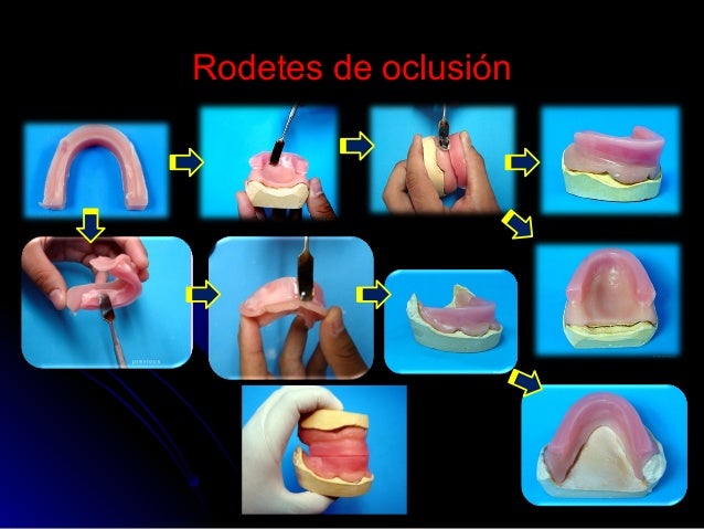 Prueba de rodetes y registros en protesis total