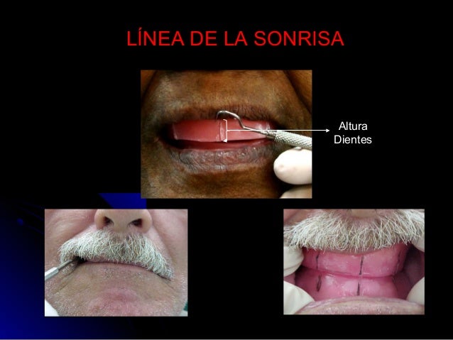 Prueba de rodetes y registros en protesis total