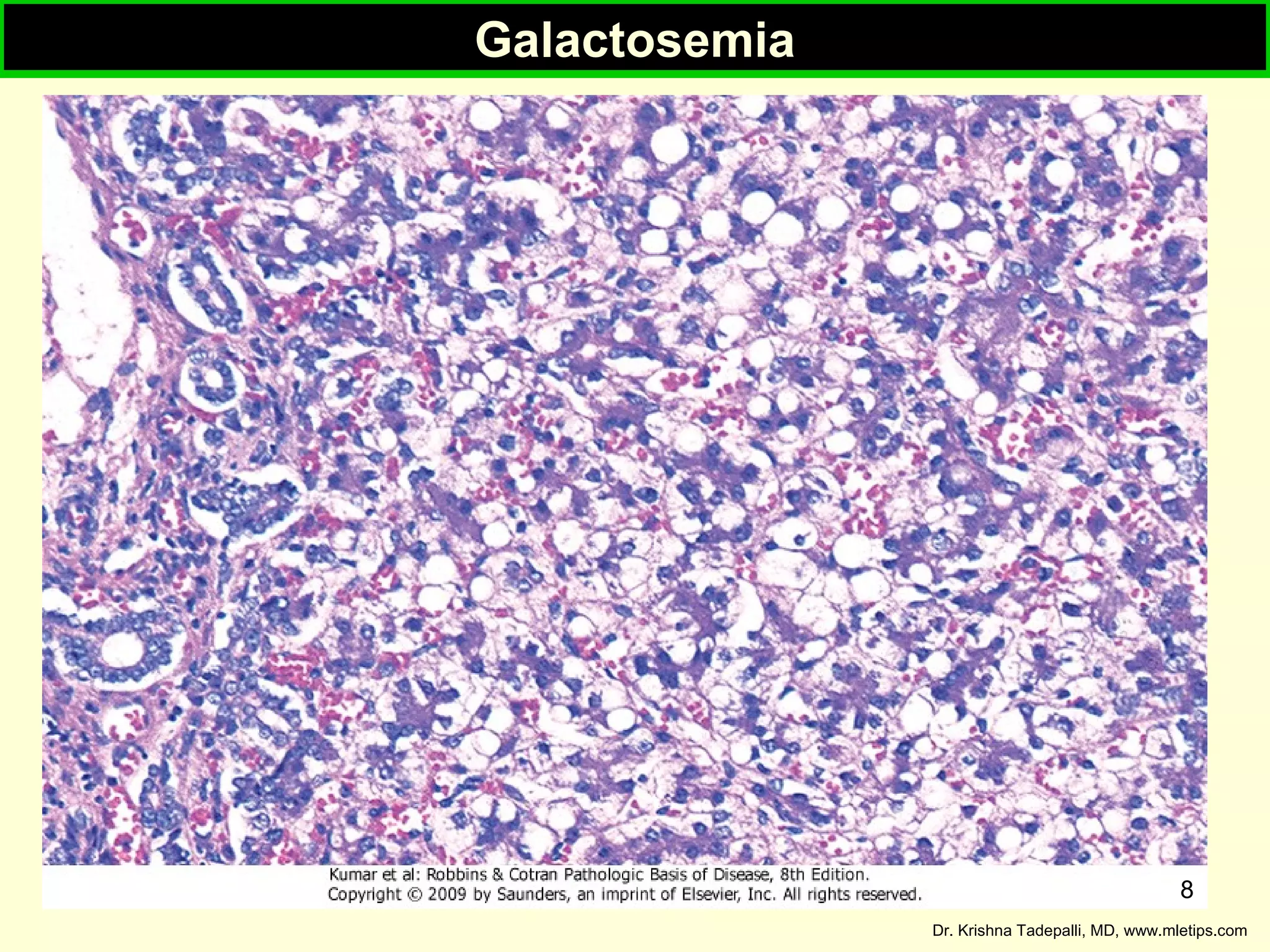 5. metabolic and genetic disorders; pediatric pathology | PPT