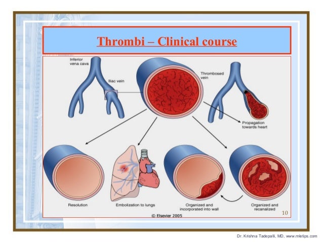 5. thrombosis; hemodynamic disorders