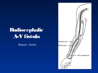 Fistula arterio-venoasa la pacientii dializati | PPT
