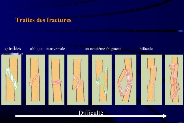 5.fracturi generalitati fr