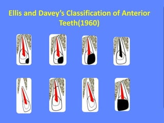 Restoration of traumatically fractured anterior teeth | PPT