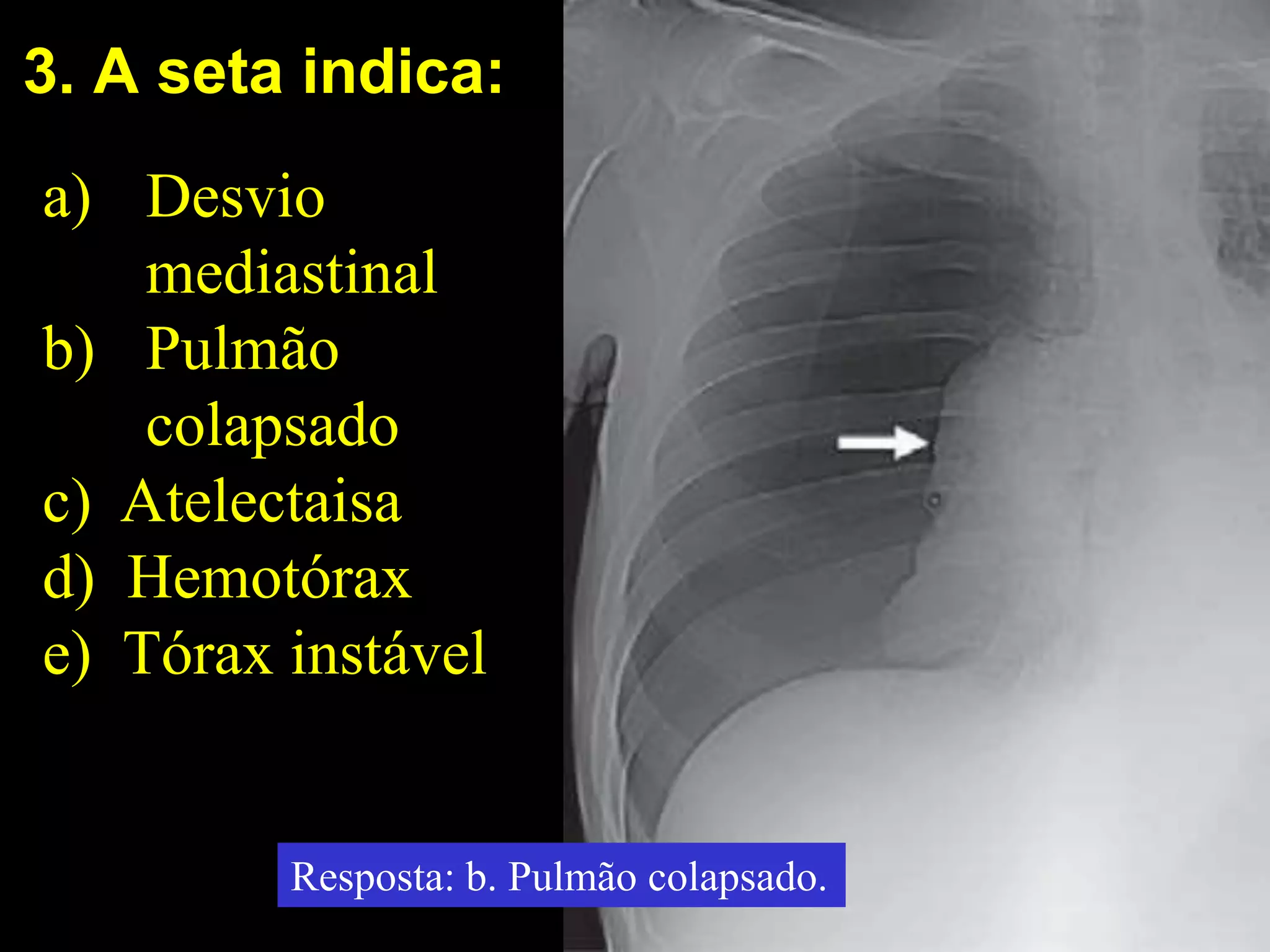 5. teste sobre tórax rx do trauma | PPT