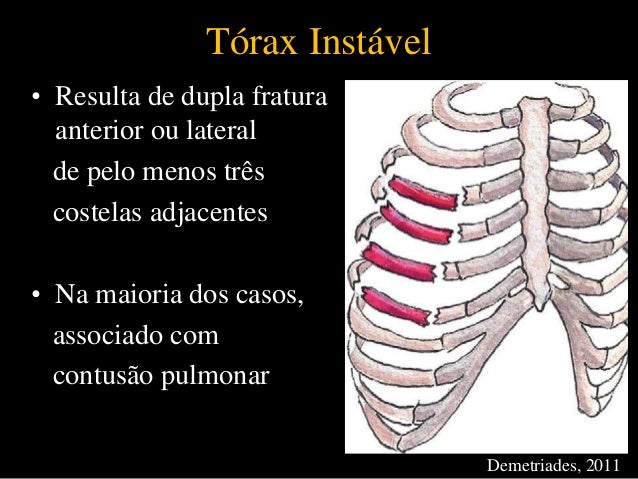 5. tórax e risco de morte rx do trauma