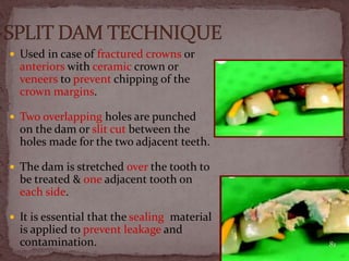 Isolation Of Dental Operating Field | PPTX