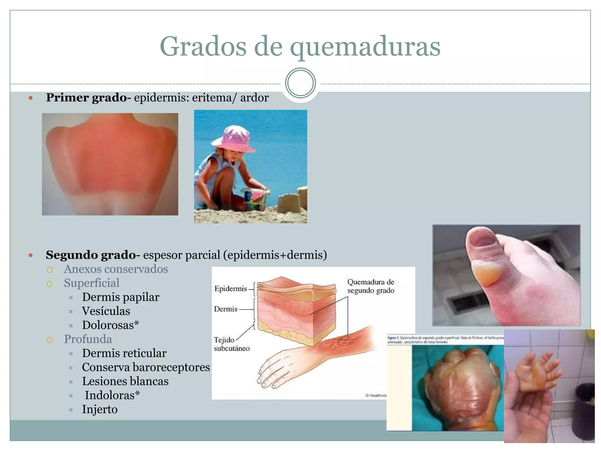 Quemaduras en Pediatría por Nadia Menéndez Auld | PPTX | Lung and ...