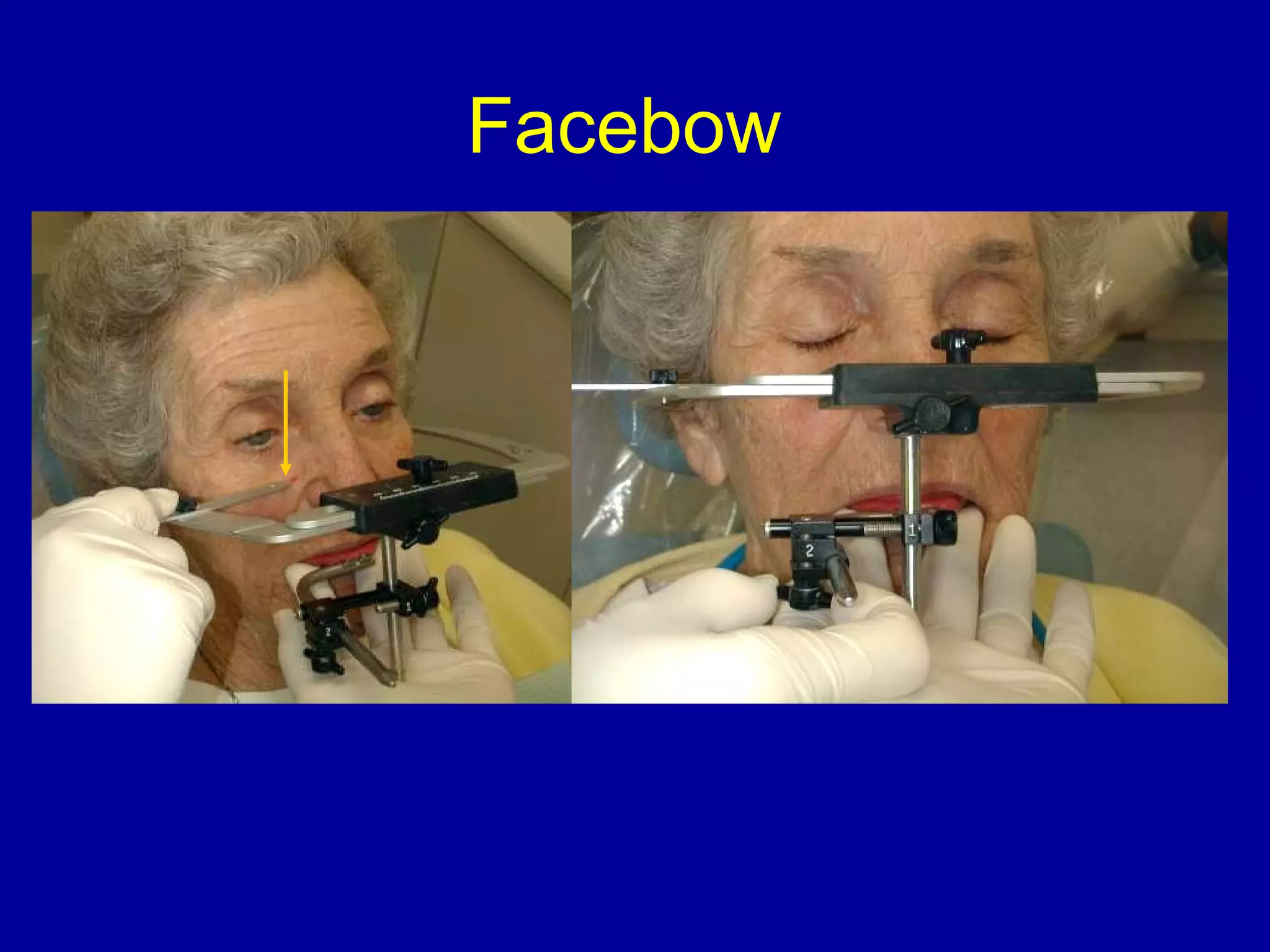 record bases & occlusal rims | PPT