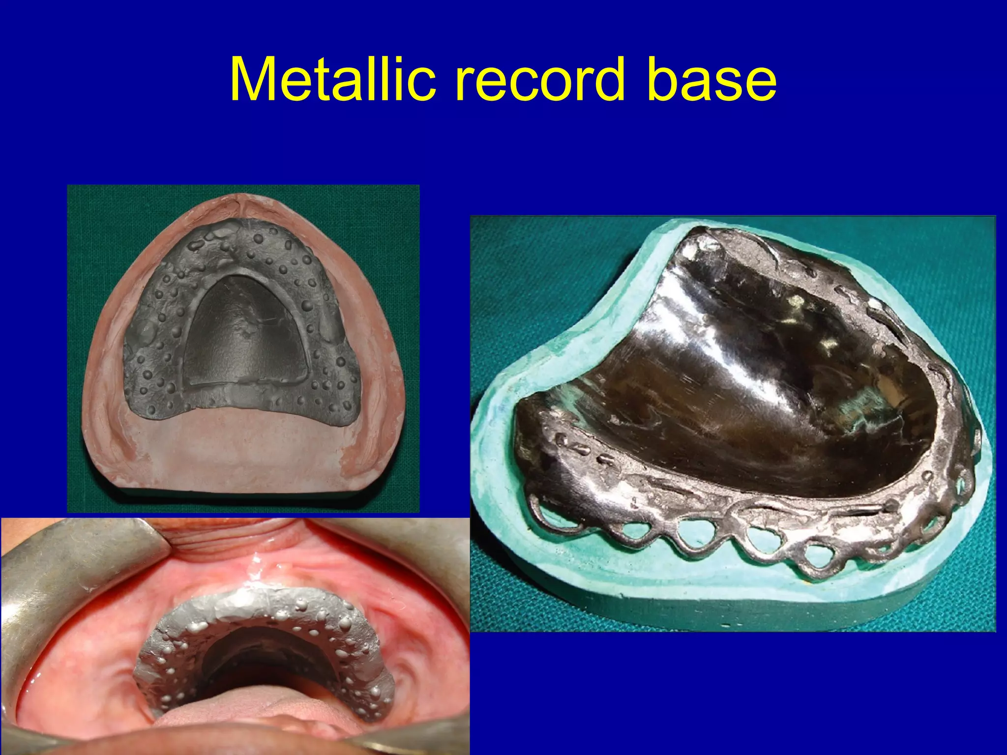 record bases & occlusal rims | PPT