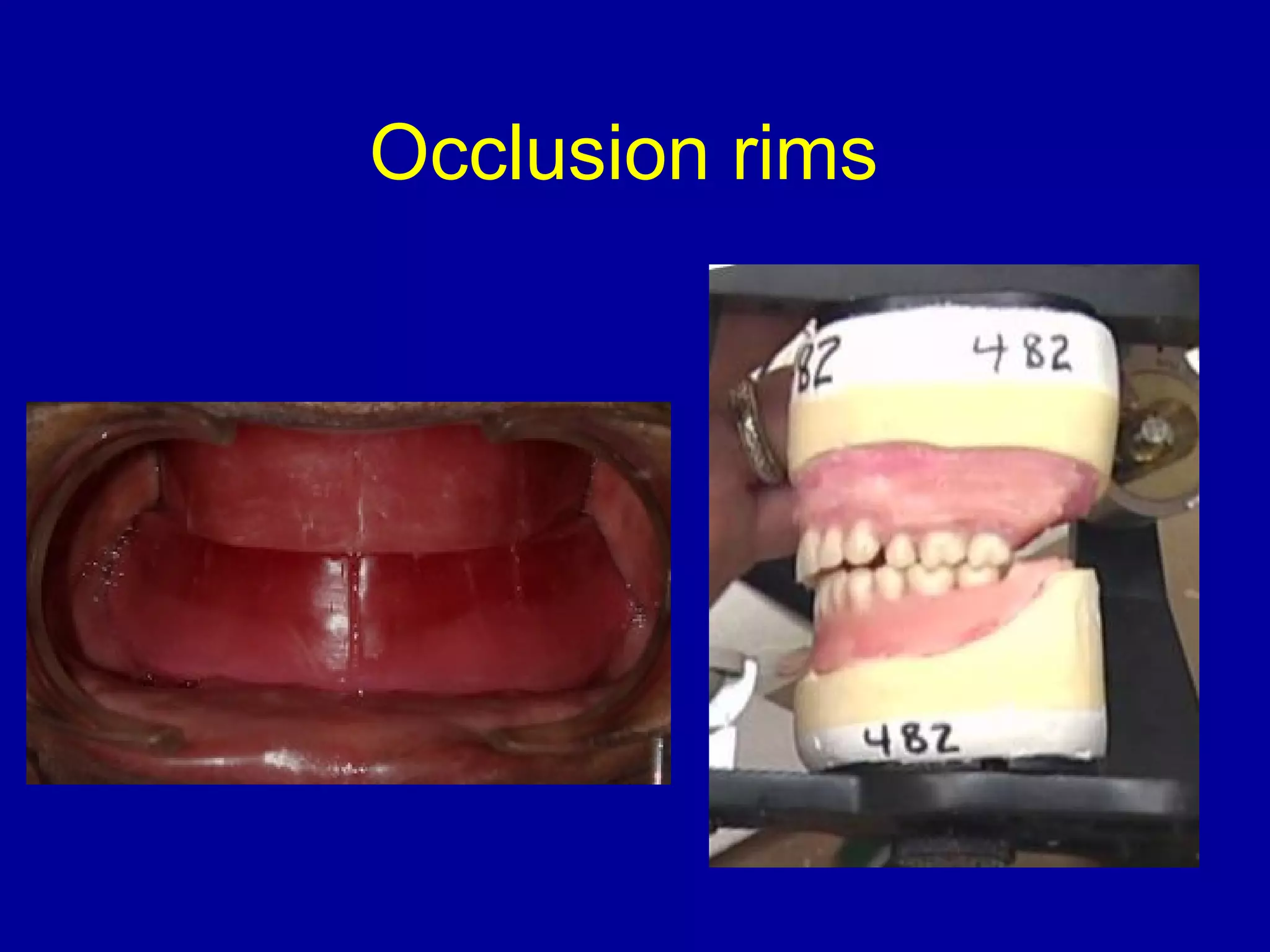 record bases & occlusal rims | PPT