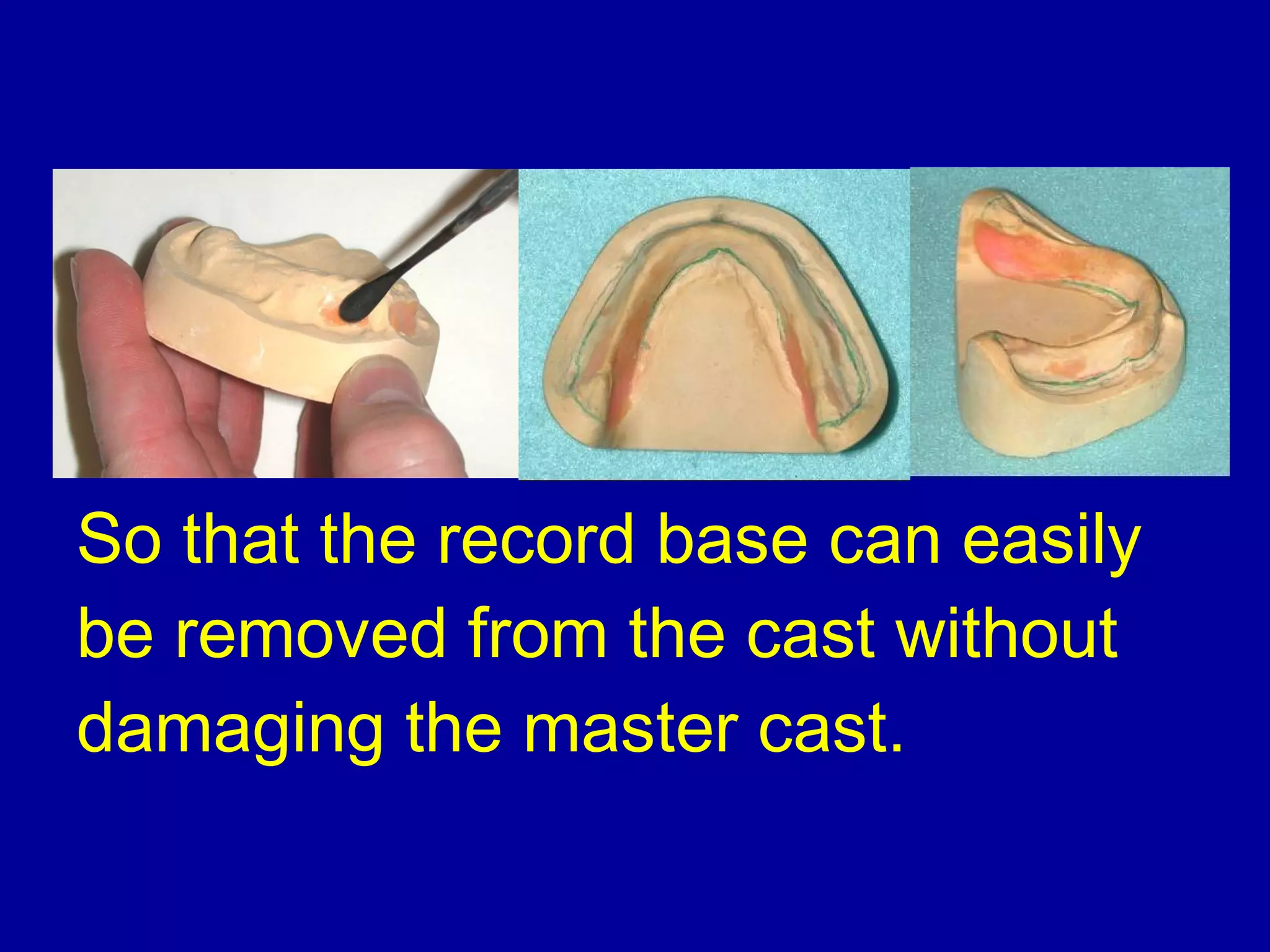 record bases & occlusal rims | PPT