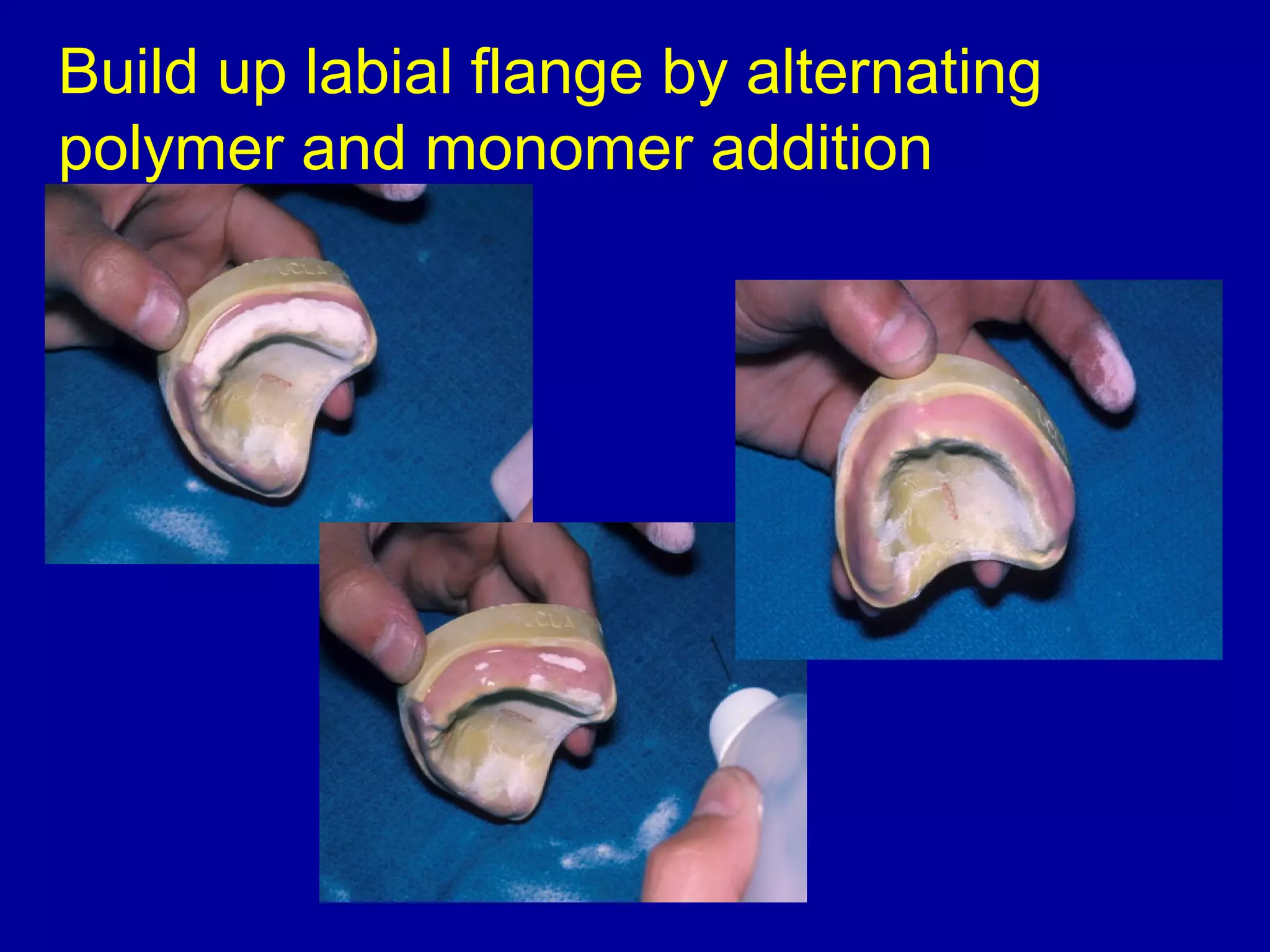 record bases & occlusal rims | PPT