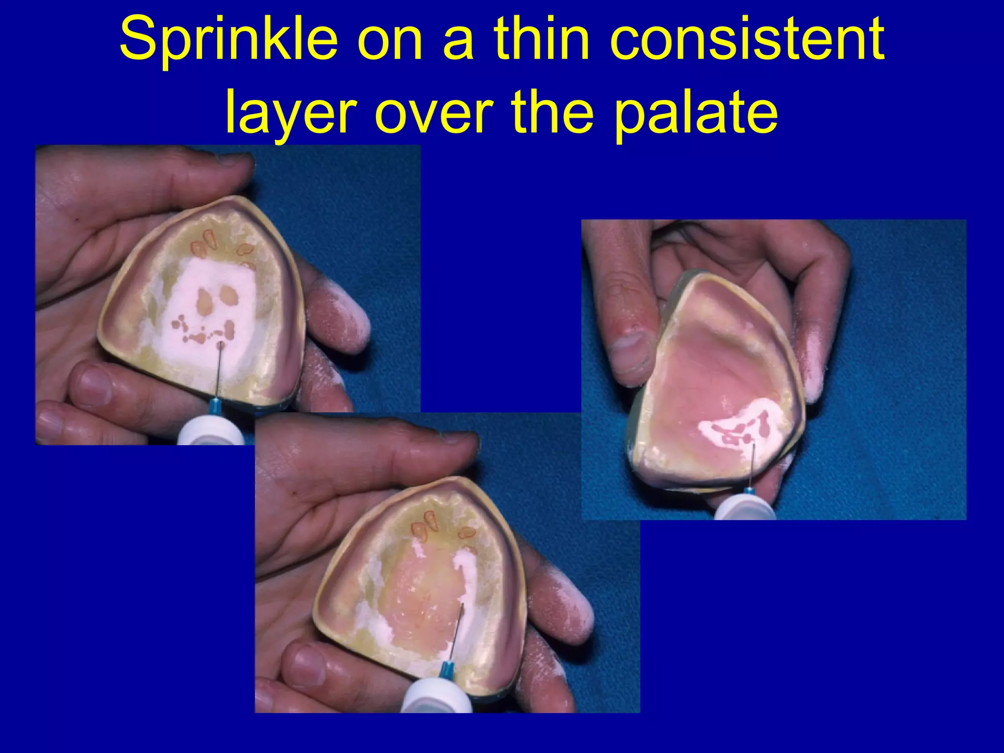 record bases & occlusal rims | PPT