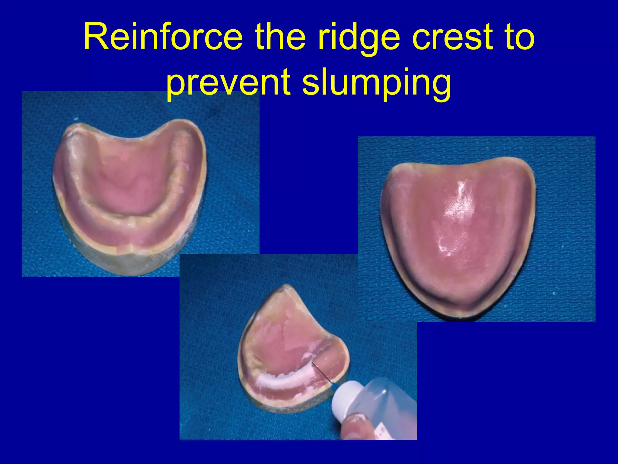 record bases & occlusal rims | PPT