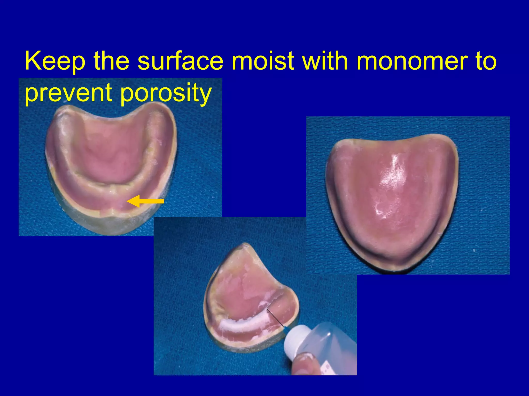 record bases & occlusal rims | PPT