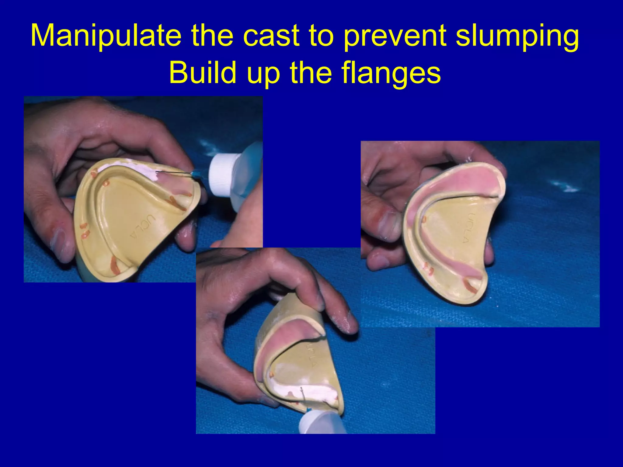 record bases & occlusal rims | PPT