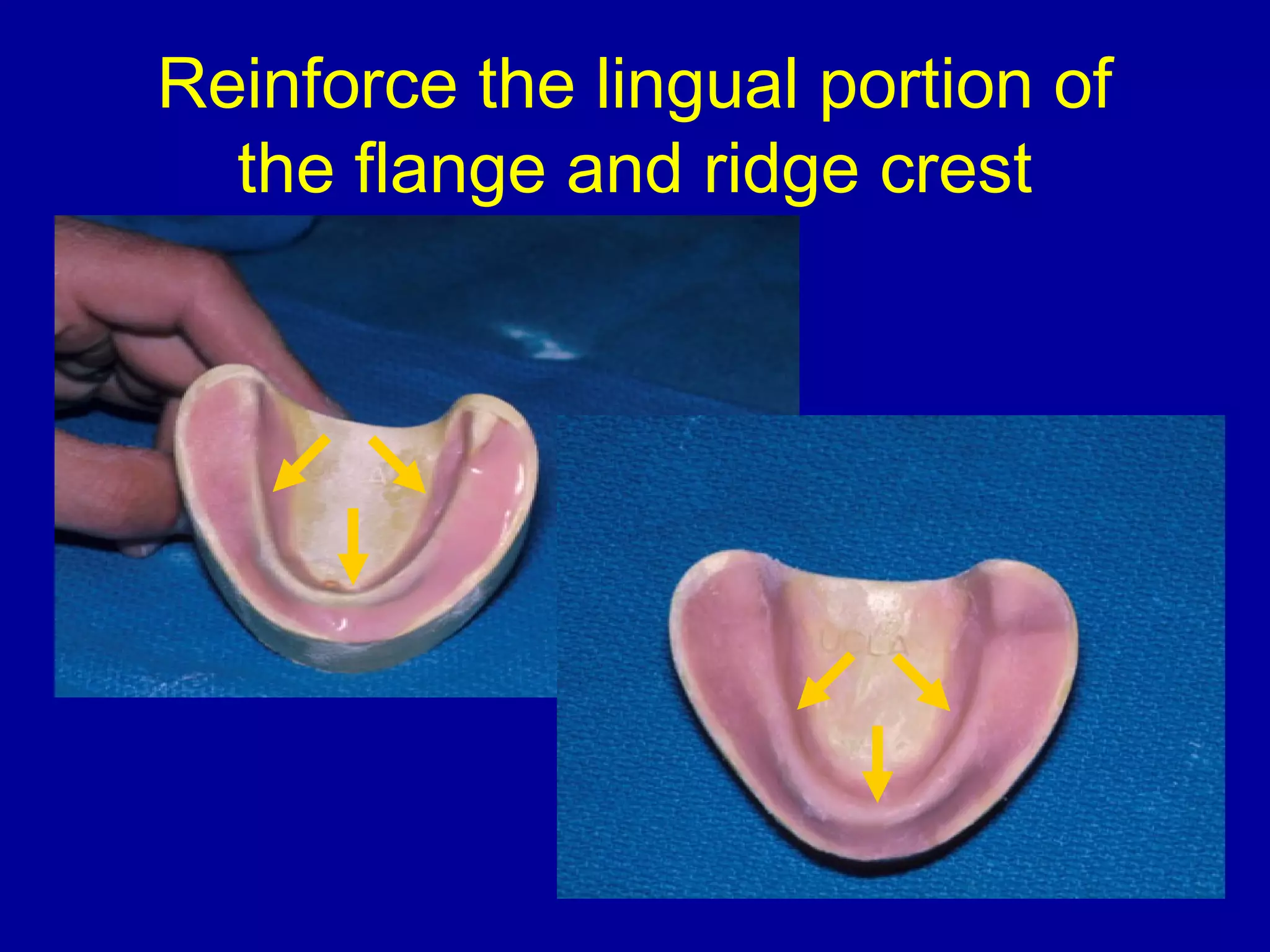 record bases & occlusal rims | PPT