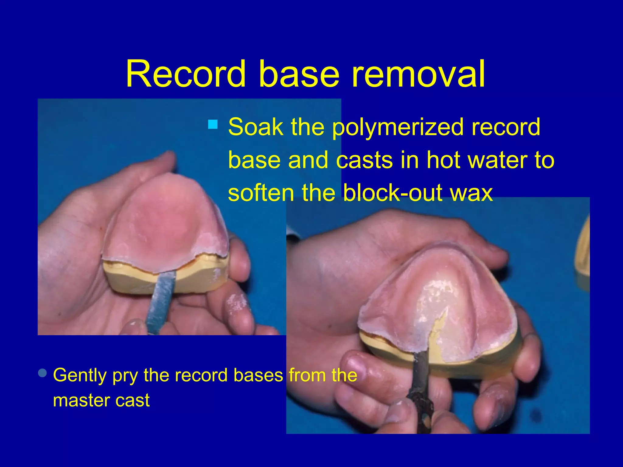 record bases & occlusal rims | PPT