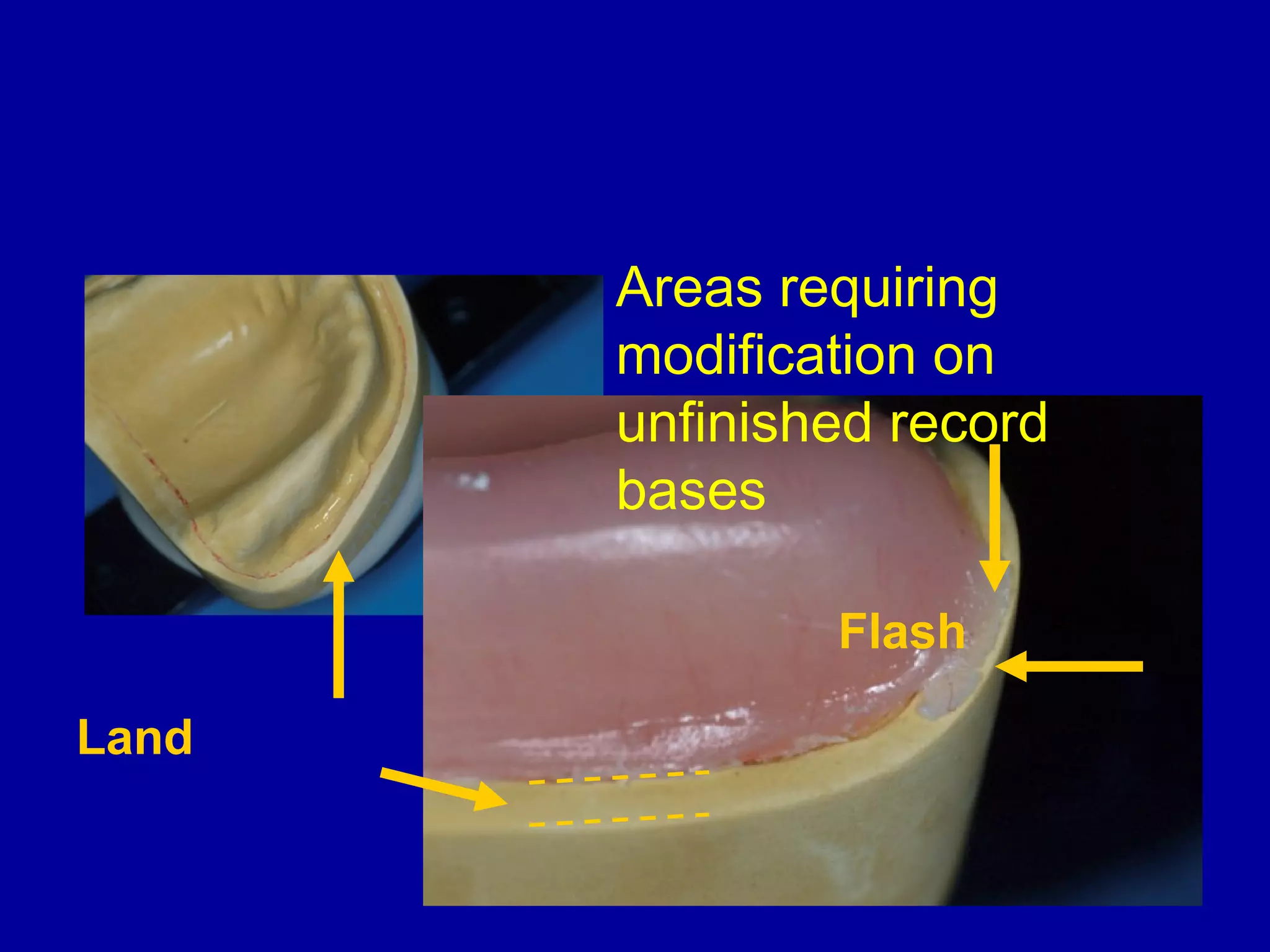 record bases & occlusal rims | PPT