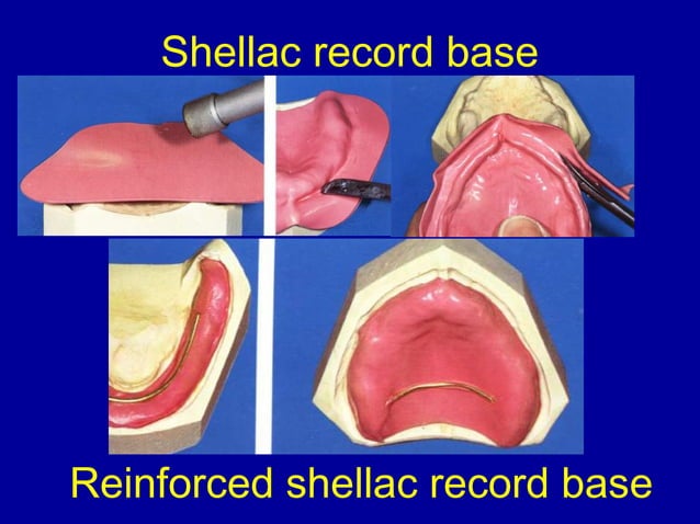 record bases & occlusal rims | PPT
