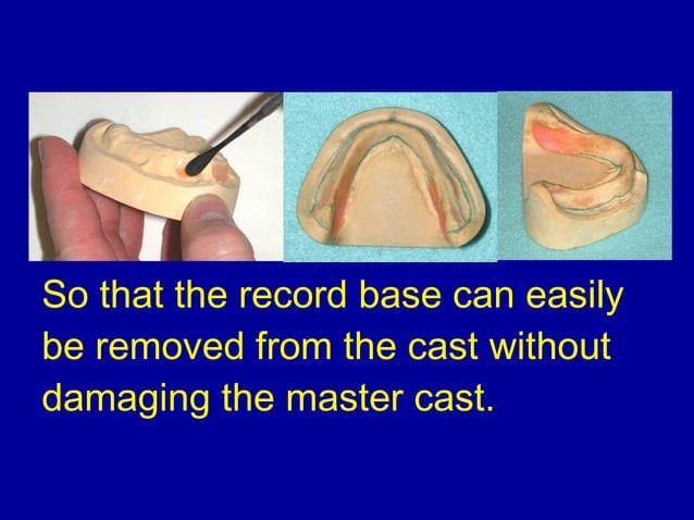 record bases & occlusal rims | PPT