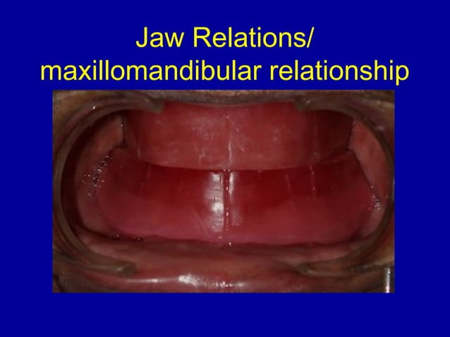 record bases & occlusal rims | PPT
