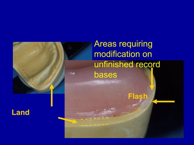 record bases & occlusal rims | PPT