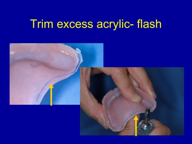 record bases & occlusal rims | PPT