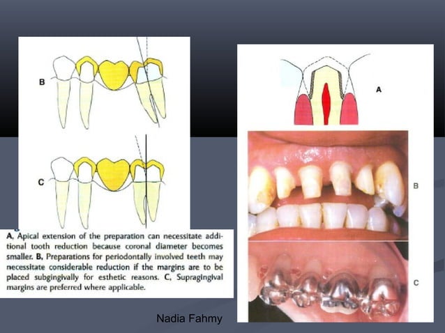 5.biologic considerations in fixed restorations 2013 | PPT | Dental ...