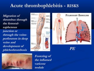pulmonary embolism | PPT
