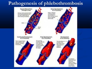 pulmonary embolism | PPT
