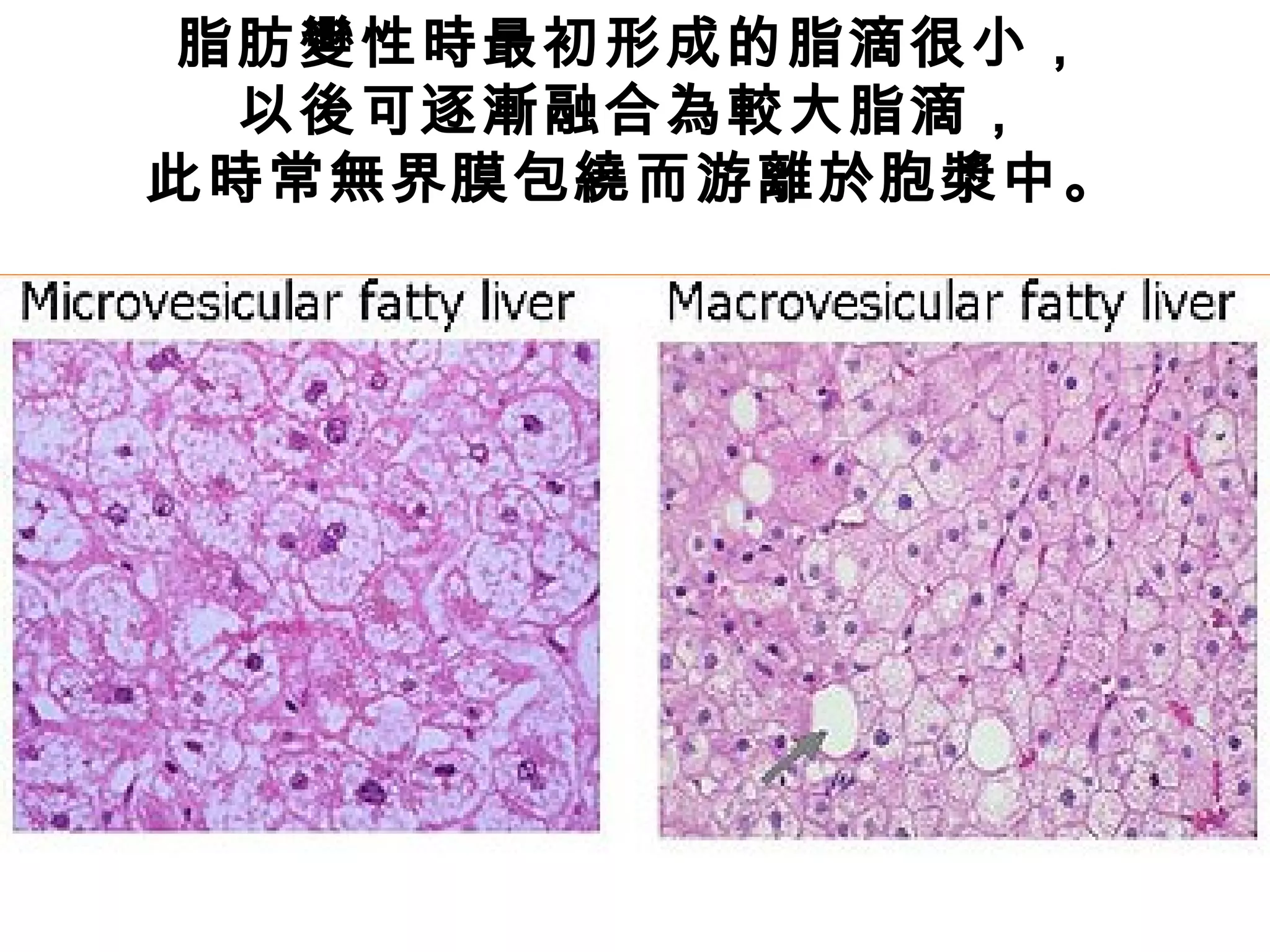 Understanding Fatty Liver Disease | PPT
