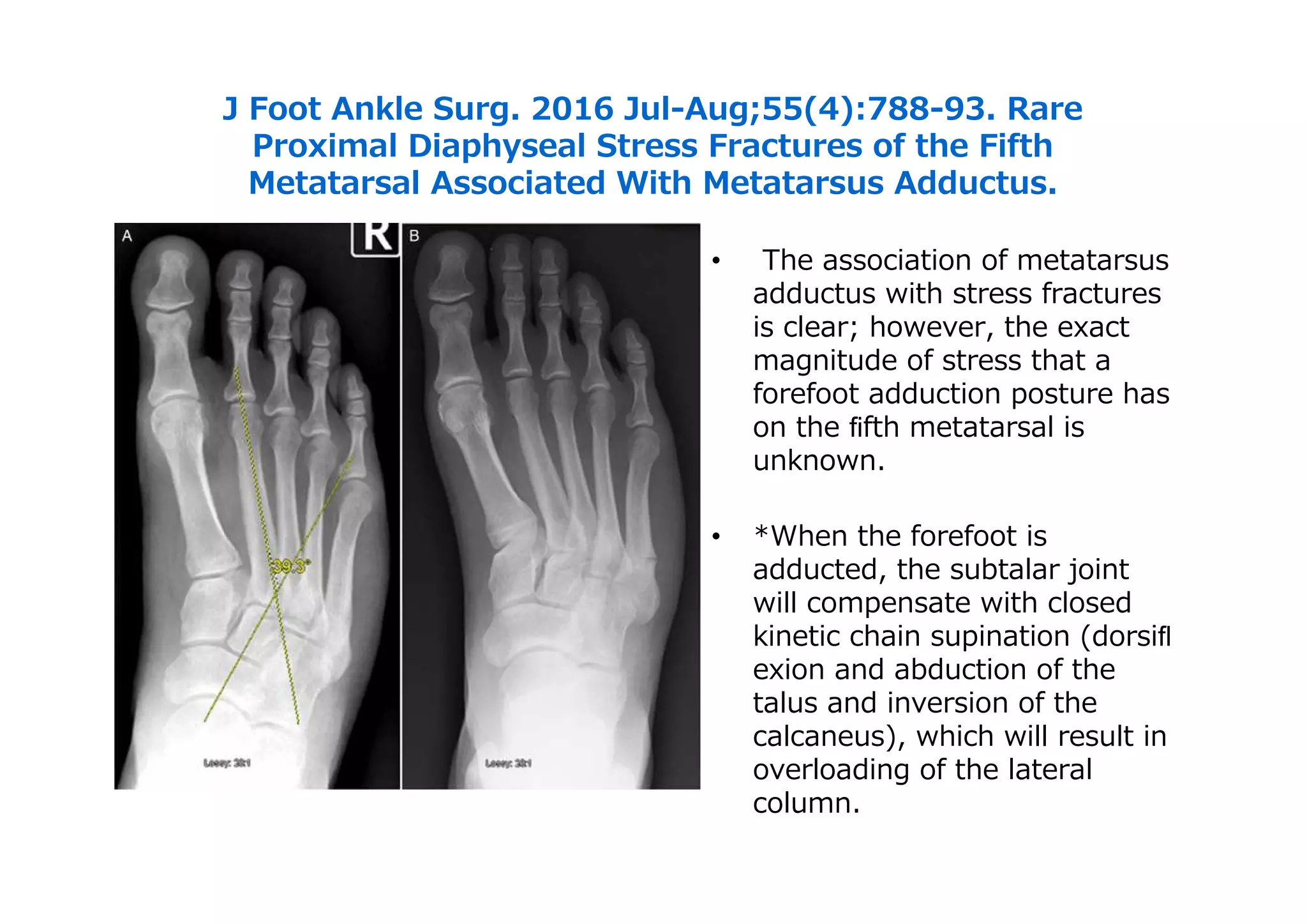 第5中足骨骨折に関する文献 The fracture mechanism of fifth metatarsal bone | PDF