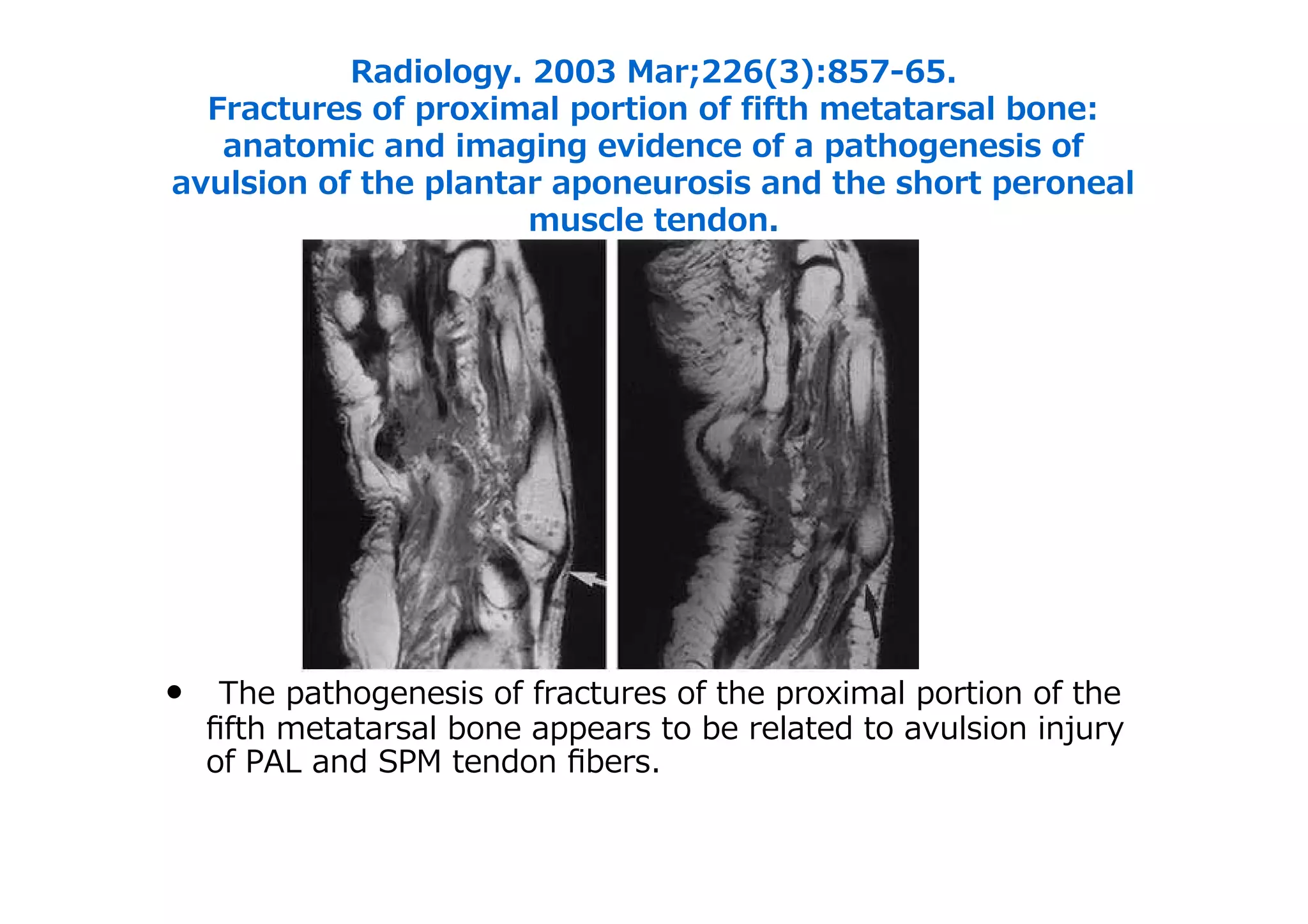 第5中足骨骨折に関する文献 The fracture mechanism of fifth metatarsal bone | PDF