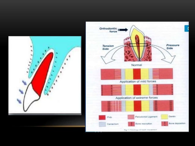 Space closure in orthodontics by elastics | PPTX | Dental Health ...