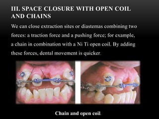 Space closure in orthodontics by elastics | PPTX