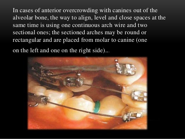 Space closure in orthodontics by elastics