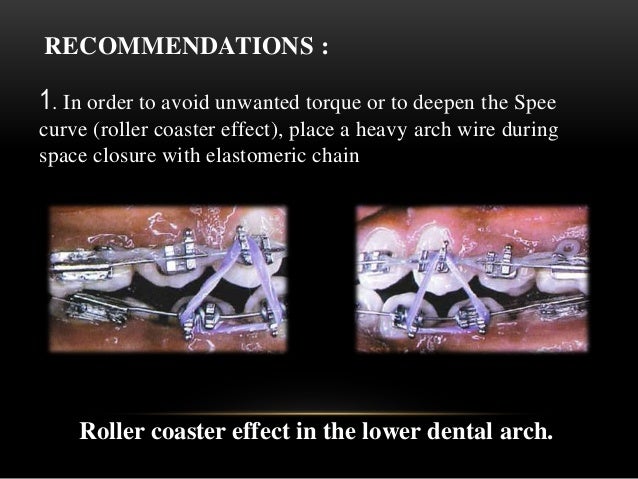 Space closure in orthodontics by elastics