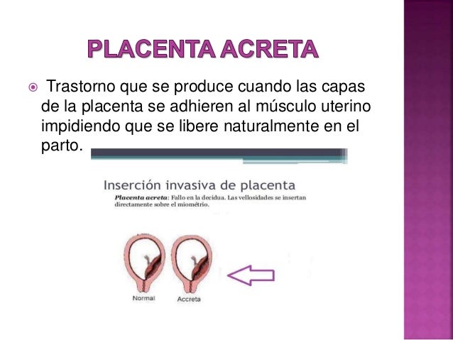 5.placenta acreta y percreta