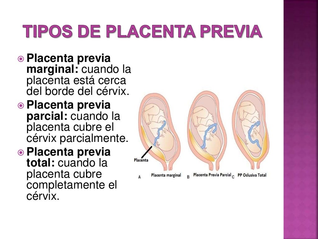 5.placenta acreta y percreta