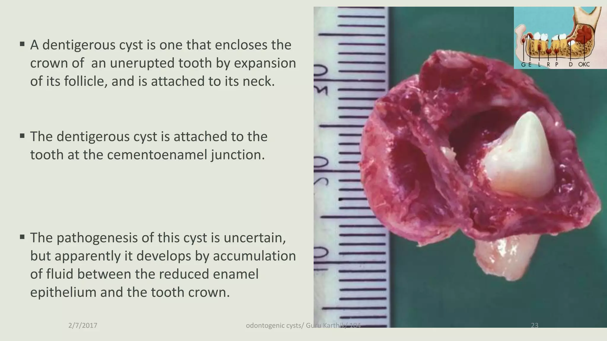 Odontogenic cysts | PPTX