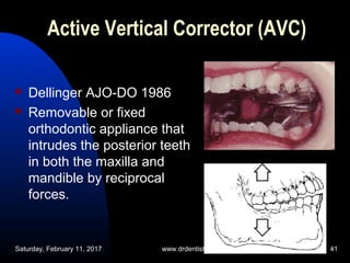 open bite and deep bite | PPT