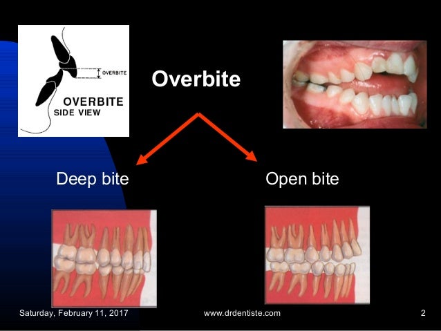 open bite and deep bite