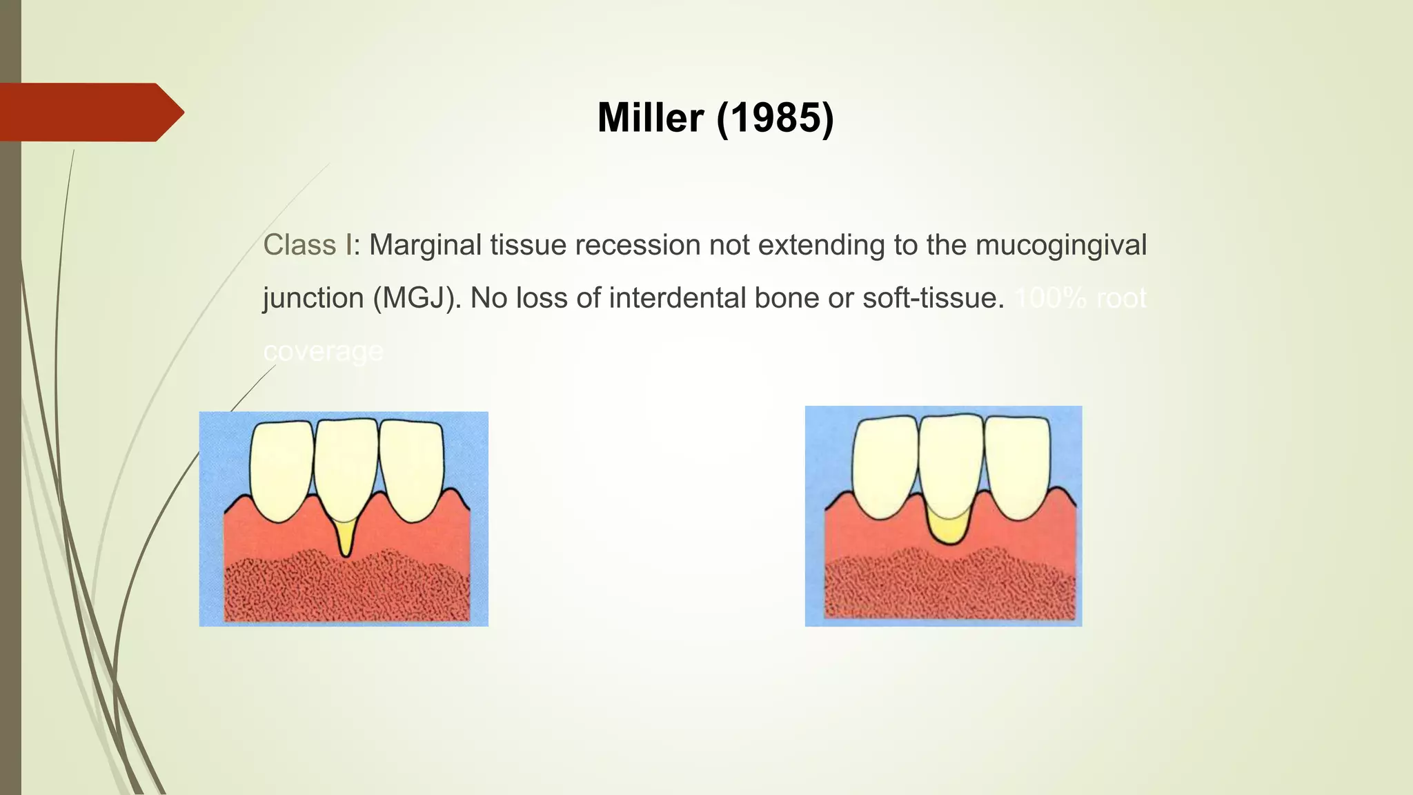 5.gingival recession seminar | PPTX
